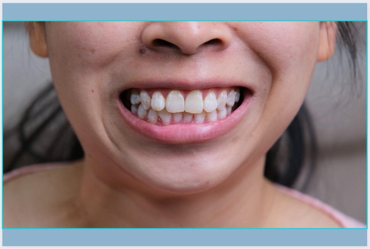 Mottled Enamel: Putting Fluorosis in Context with Dr. Levy